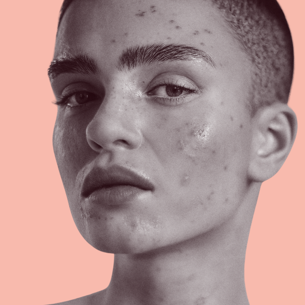 Hormonal Acne: Managing Your Skin's Cyclical Battle – Motherocity